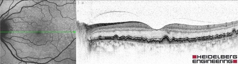 Makuladegeneration | Dr. Corinna Rathei in Graz